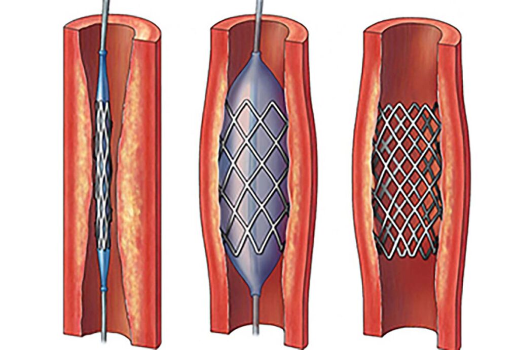 Stent – Doç.Dr. Nihat ŞEN